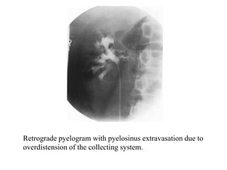 Retrograde Pyelography | PPTX