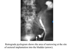 Retrograde Pyelography | PPTX