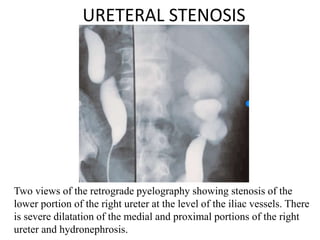 Retrograde Pyelography | PPTX