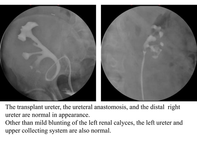 Retrograde Pyelography