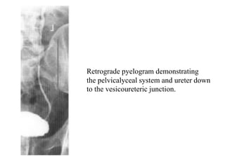 Retrograde Pyelography | PPT