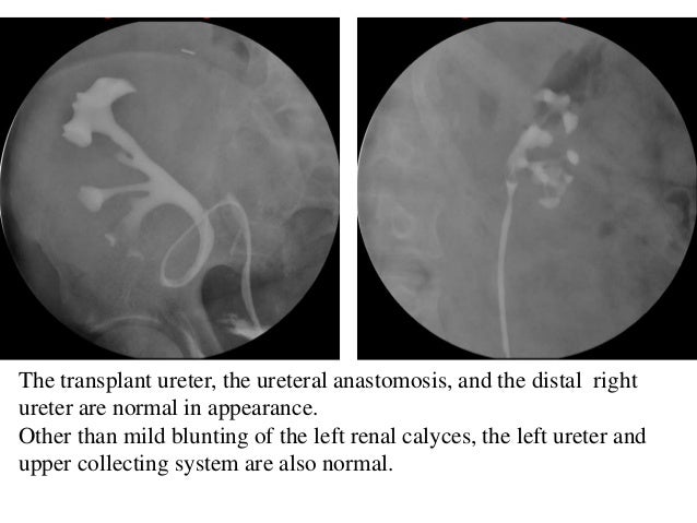 Retrograde Pyelography