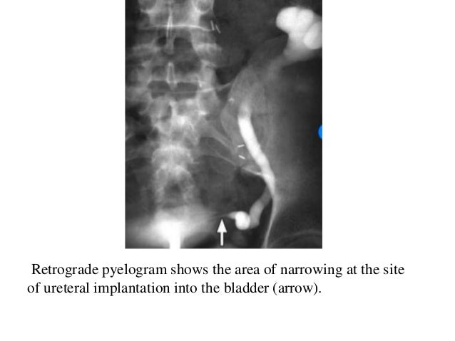 Retrograde Pyelography