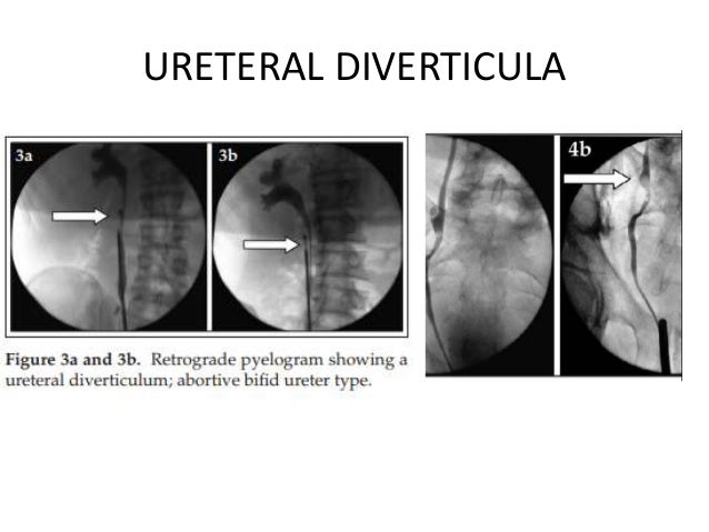 Retrograde Pyelography