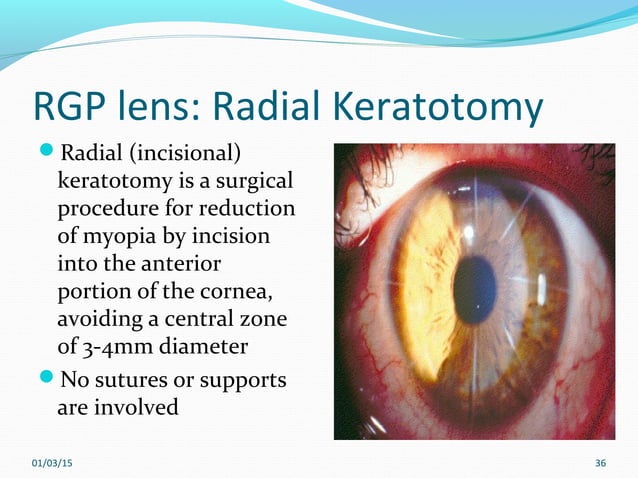 Optics of RGP contact lens | PPT
