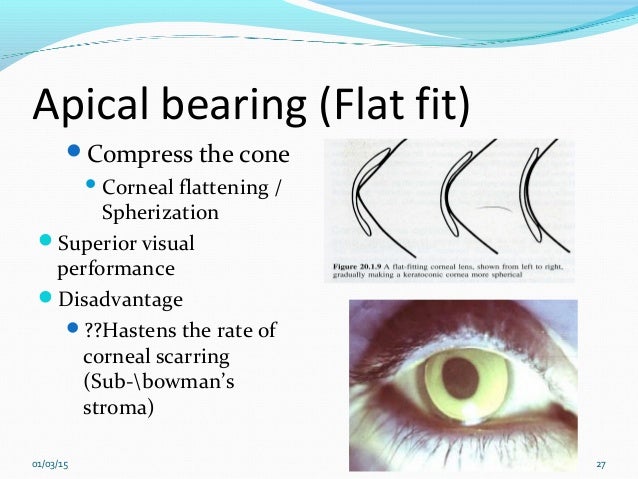 Optics of RGP contact lens