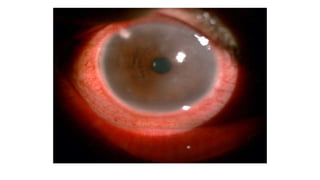 RGP Complications and Management.pptx