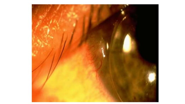 RGP Complications and Management.pptx | Eye and Vision Conditions | Diseases and Conditions