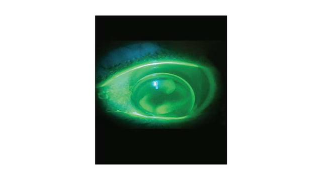 RGP Complications and Management.pptx | Eye and Vision Conditions ...