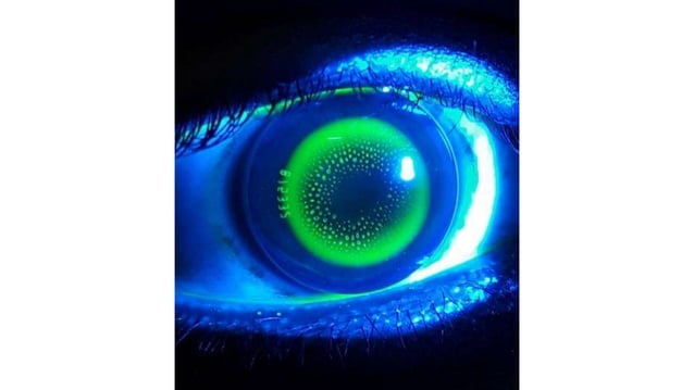 RGP Complications and Management.pptx | Eye and Vision Conditions ...