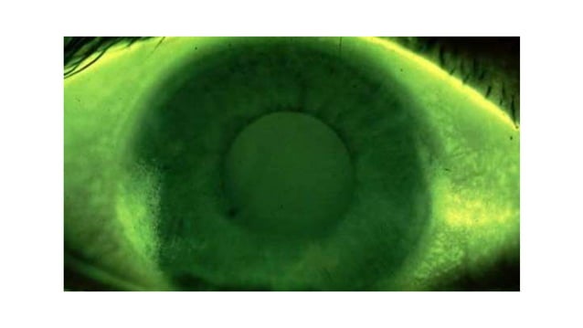 RGP Complications and Management.pptx | Eye and Vision Conditions | Diseases and Conditions