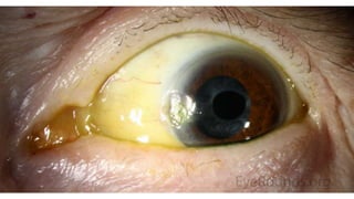 RGP Complications and Management.pptx