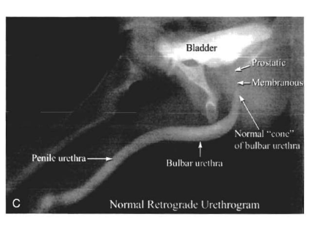 retrograde urethrogram for urology residents | PPTX