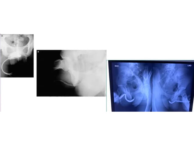 retrograde urethrogram for urology residents | PPTX