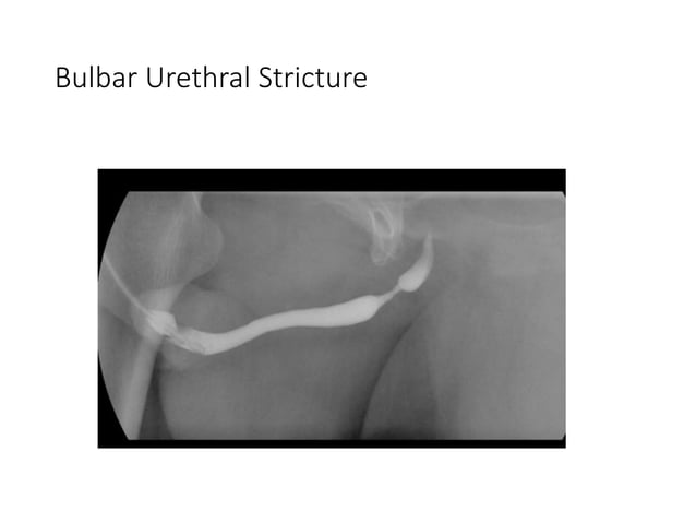 retrograde urethrogram for urology residents | PPTX