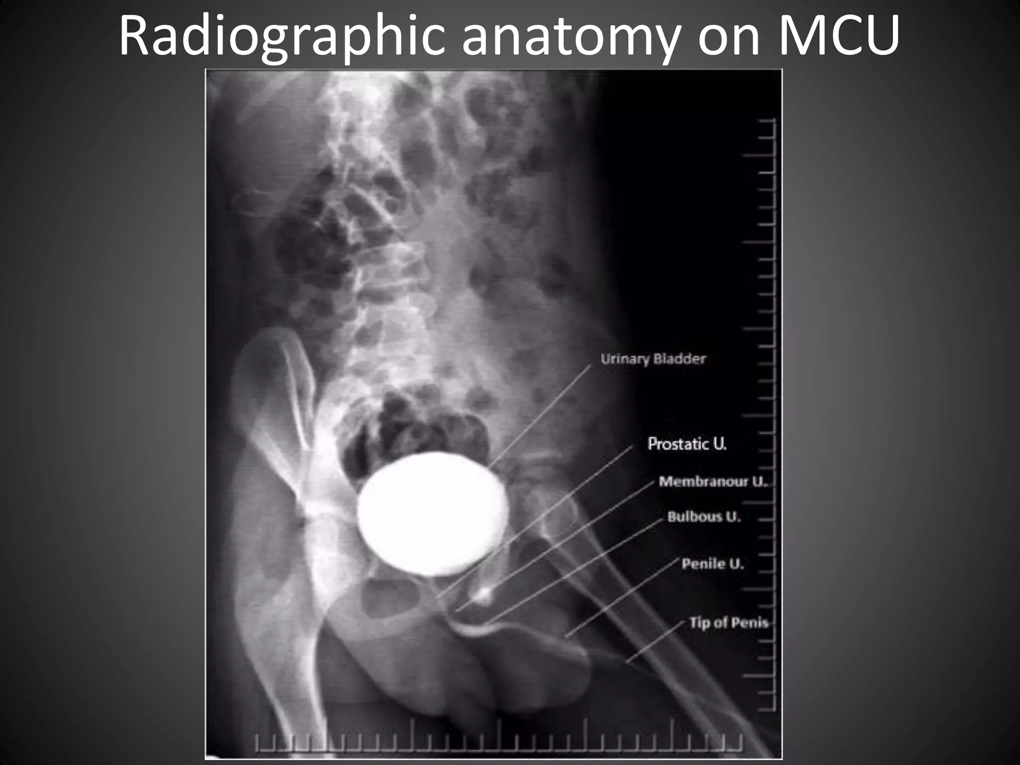 Anterograde/Retrograde urethrography (RGU/MCU) | PPTX