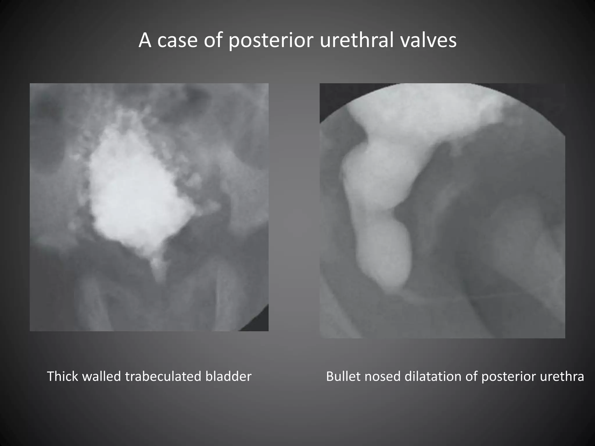 Anterograde/Retrograde urethrography (RGU/MCU) | PPTX