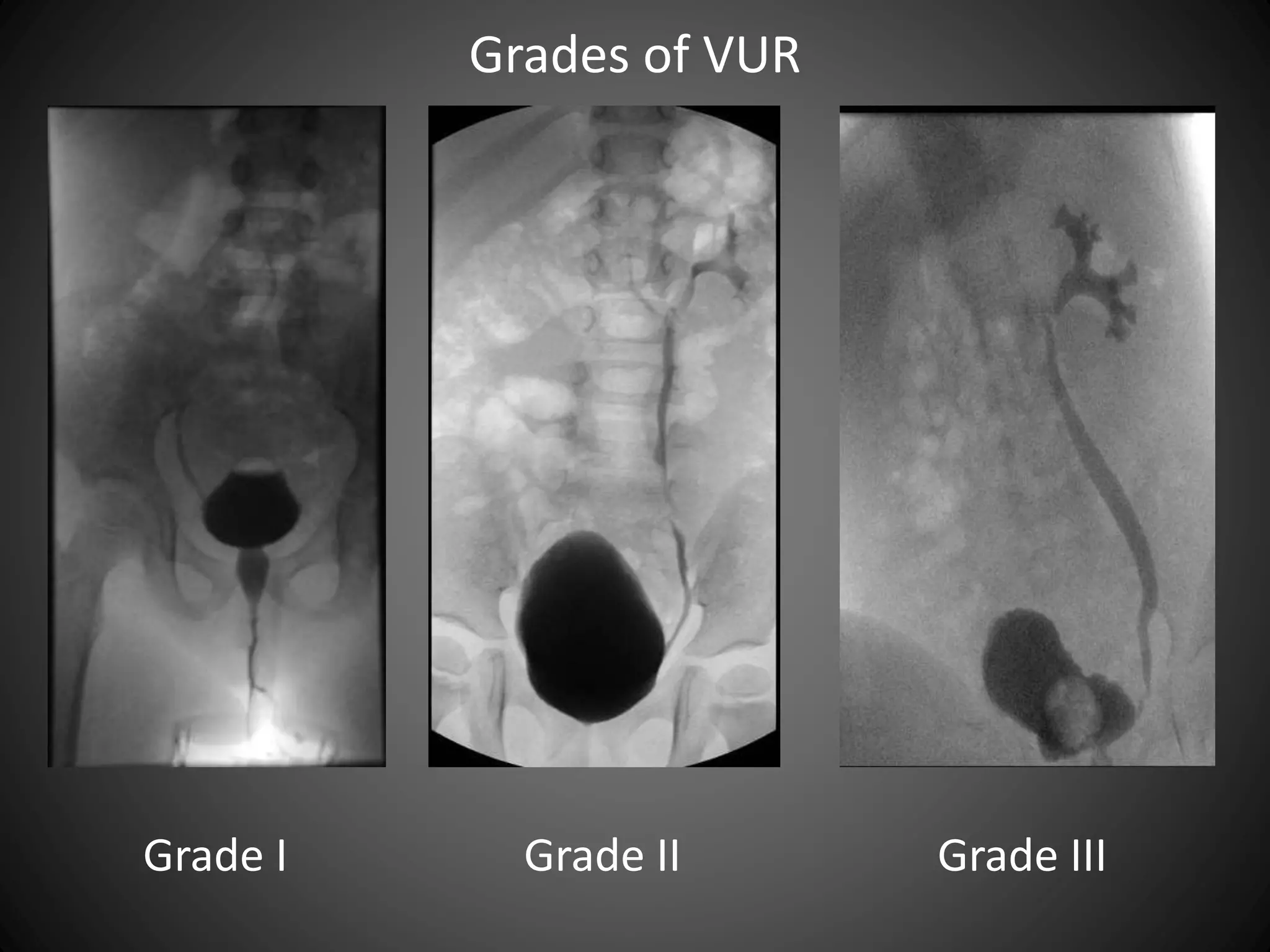 Anterograde/Retrograde urethrography (RGU/MCU) | PPTX