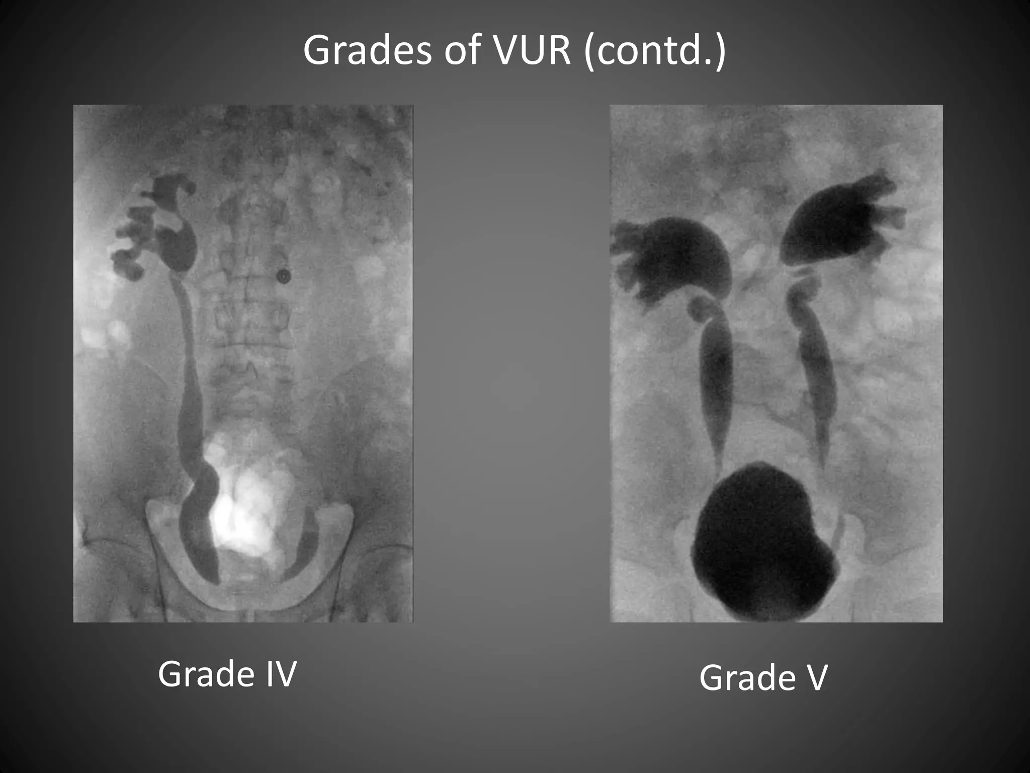 Anterograde/Retrograde urethrography (RGU/MCU) | PPTX