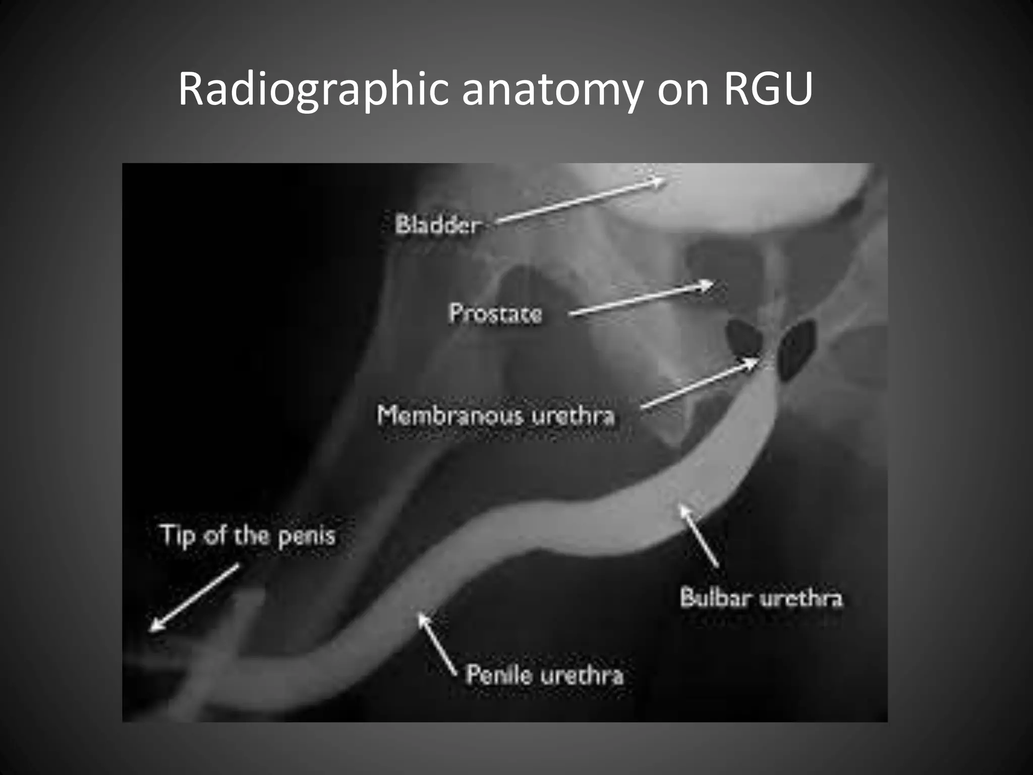 Anterograde/Retrograde urethrography (RGU/MCU) | PPTX