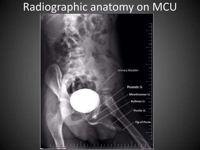 Anterograde/Retrograde urethrography (RGU/MCU)