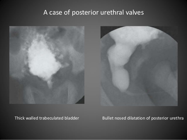 Posterior Urethral Valves Vcug