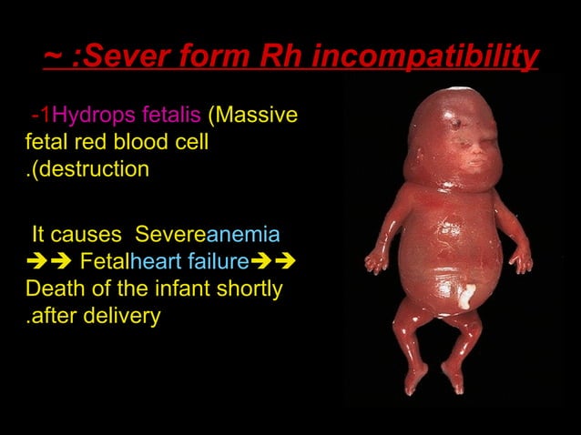 fetal circulation & Rh incompatibility | PPT