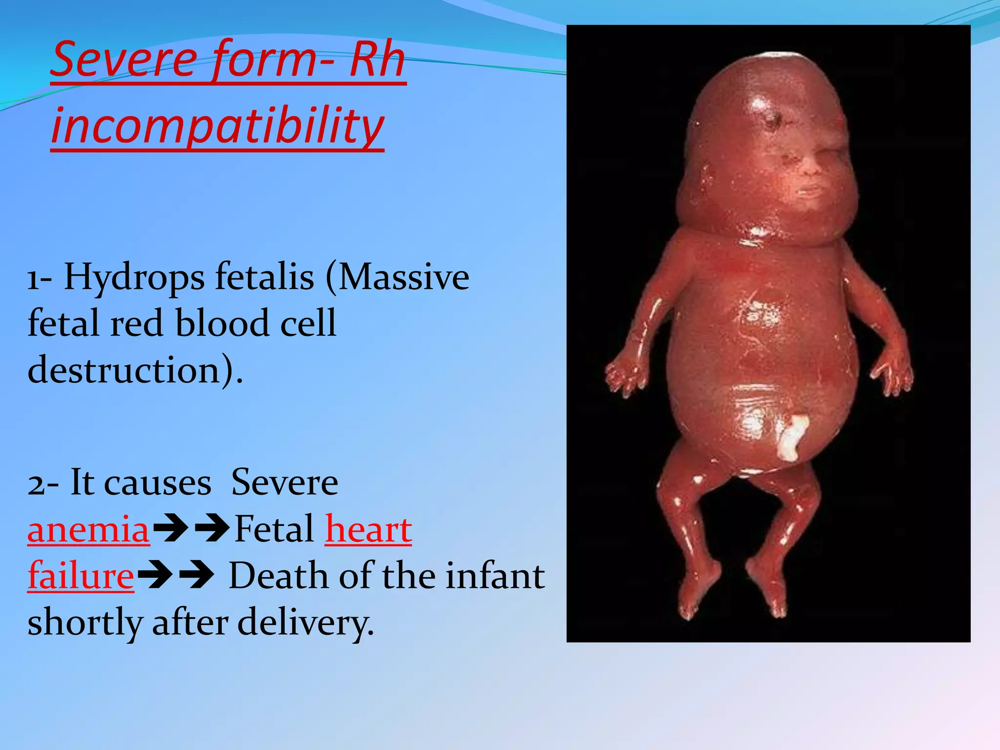 Rh incompatibility | PPTX