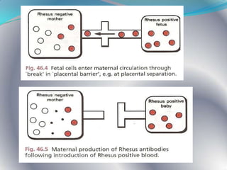Rh incompatibility | PPTX