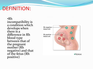 Rh incompatibility | PPTX