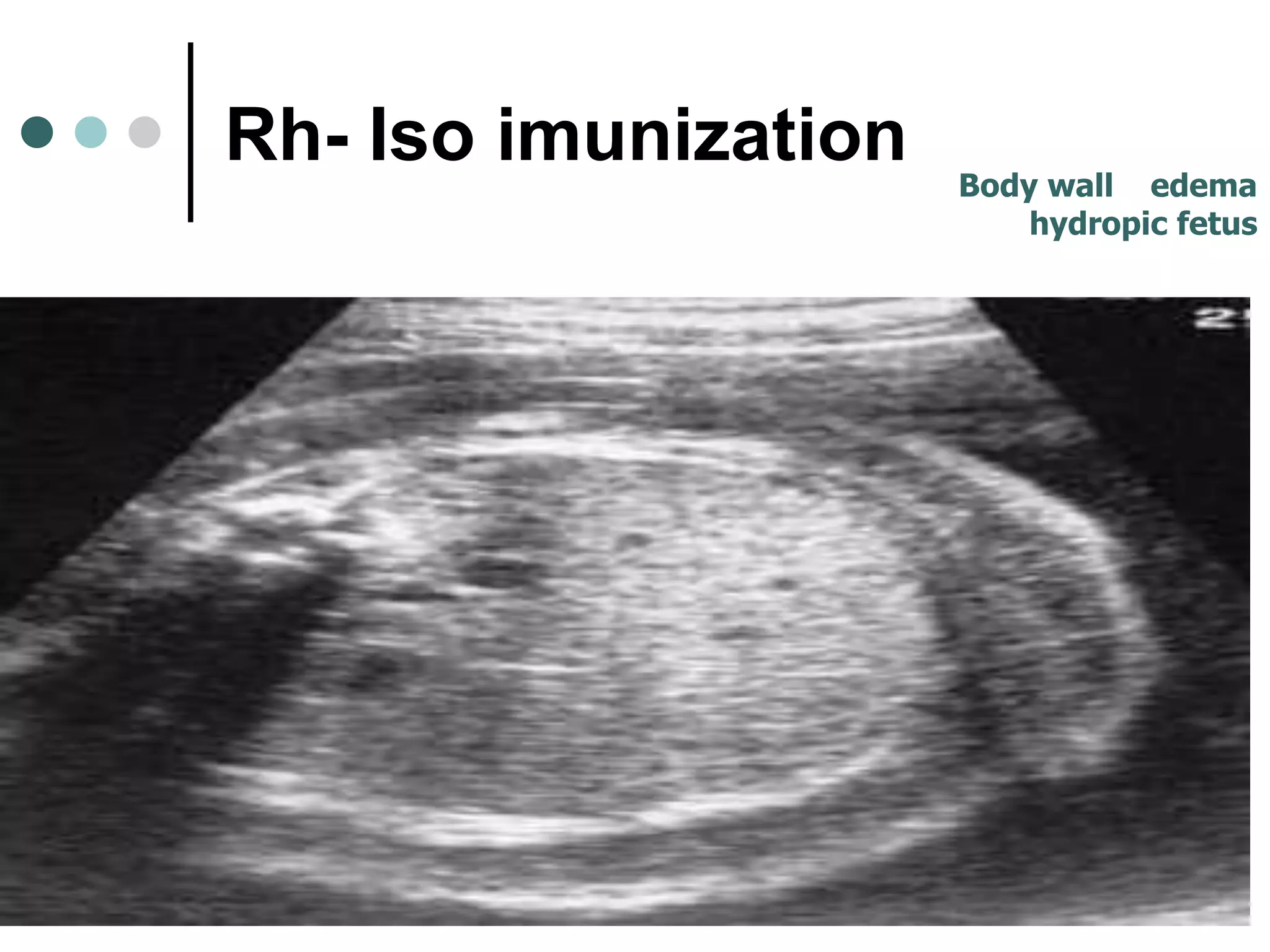Rh isoimmunization | PPTX