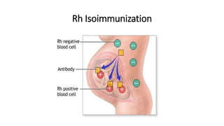 Rh iso immunization | PPTX