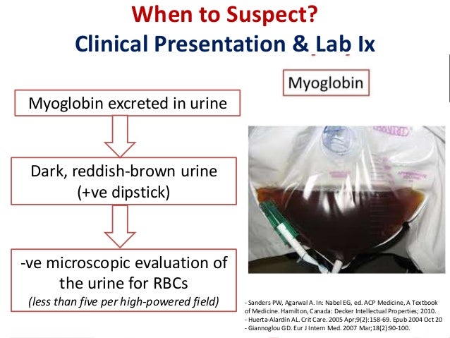 Rhabdomyolysis - Form Pathogenesis to Bedside