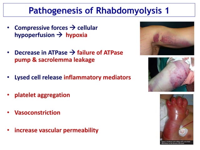 Rhabdomyolysis