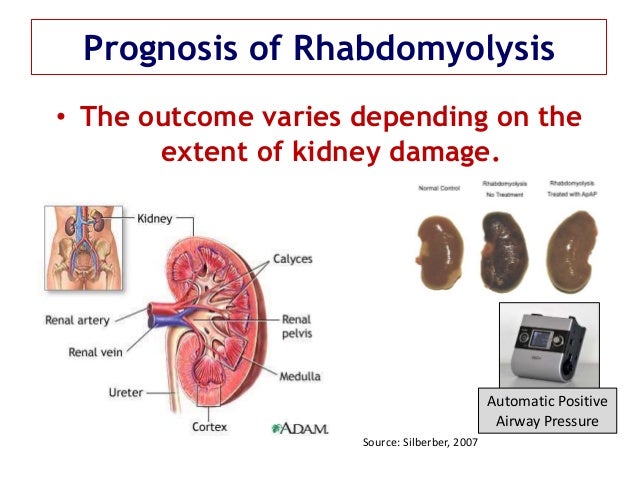 Rhabdomyolysis
