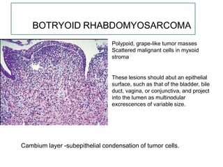 Rhabdomyosarcoma | PPT