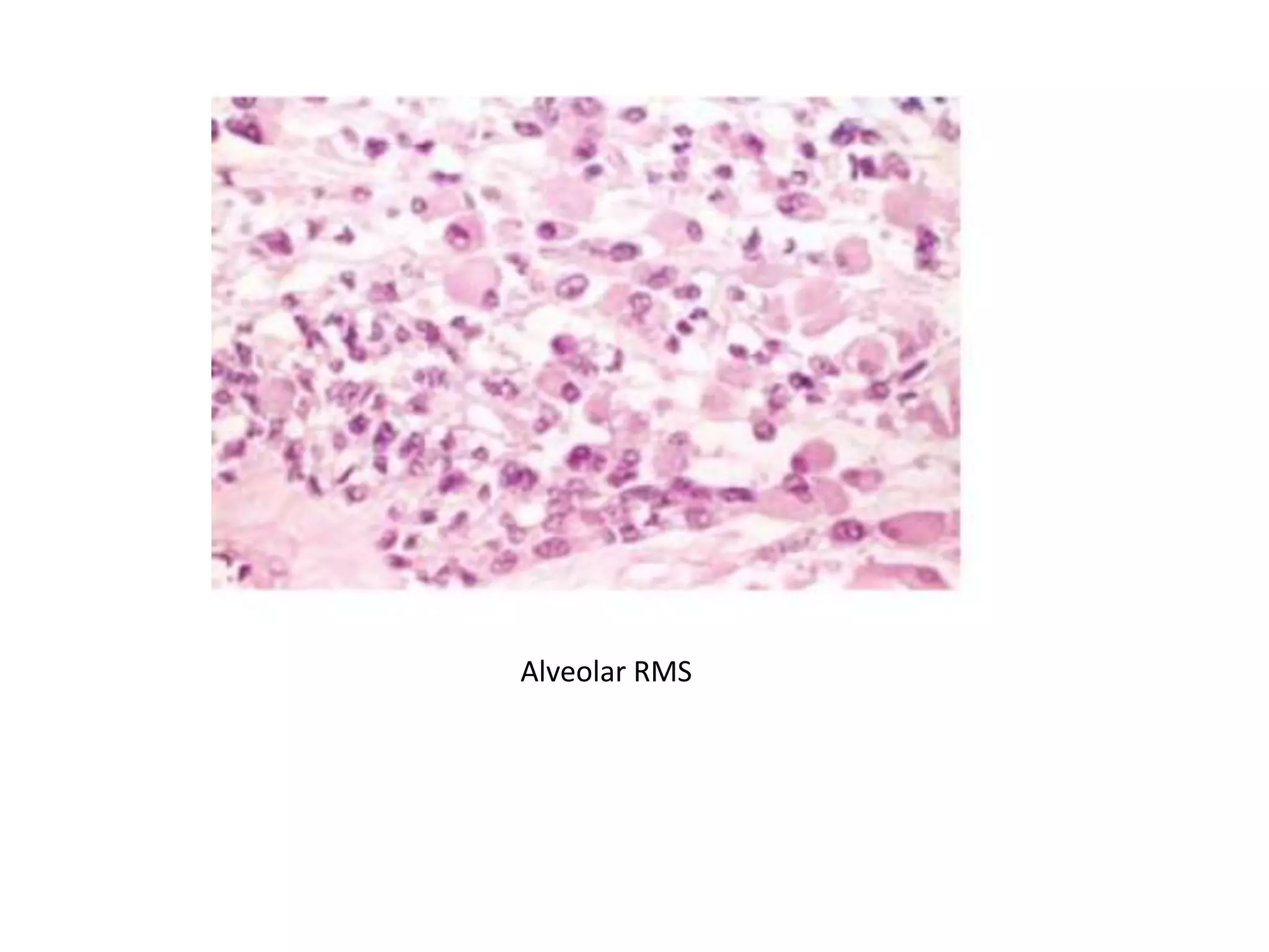 Rhabdomyosarcoma of urinary bladder | PPTX