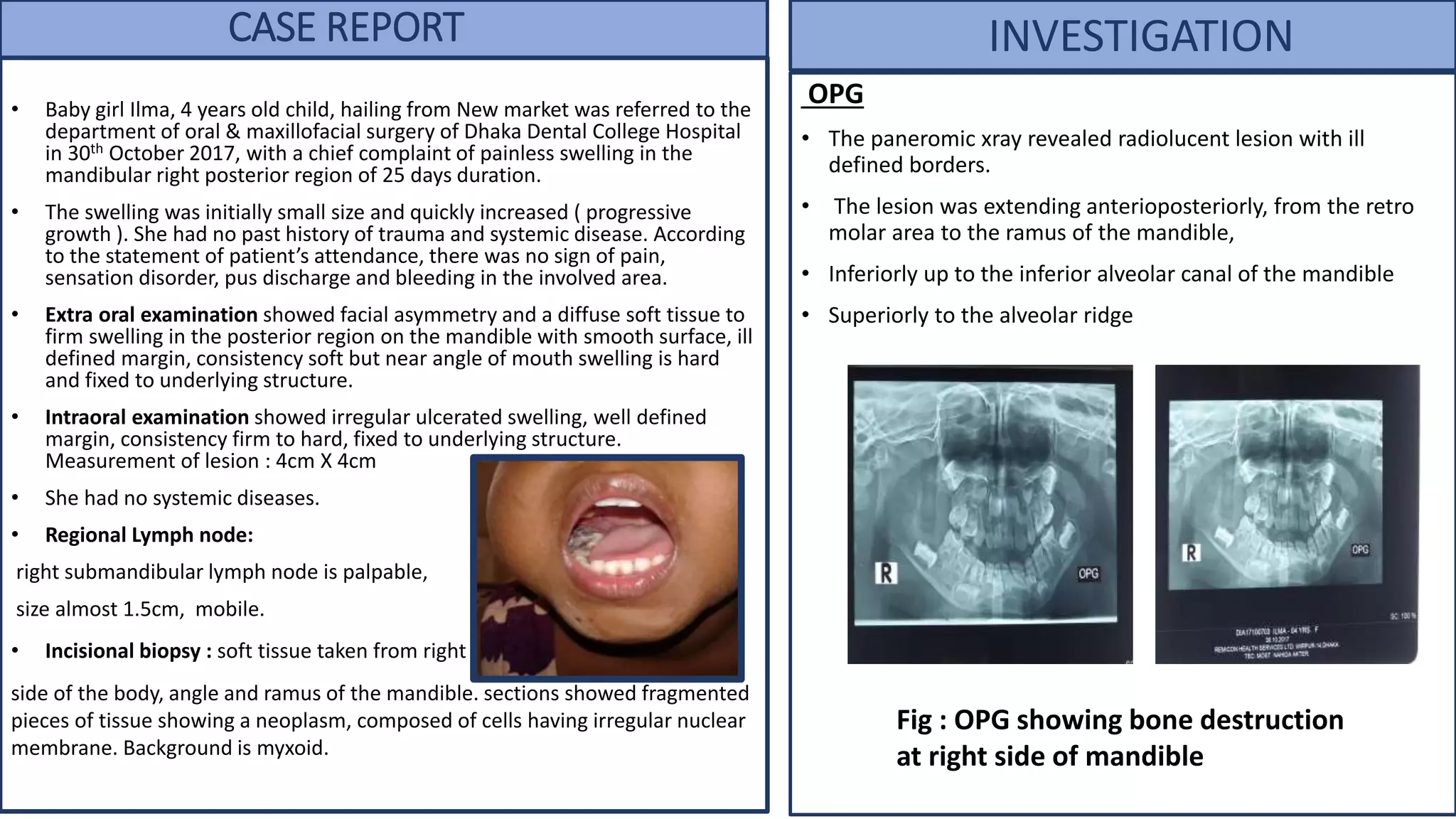 Rhabdomyosarcoma | PPTX