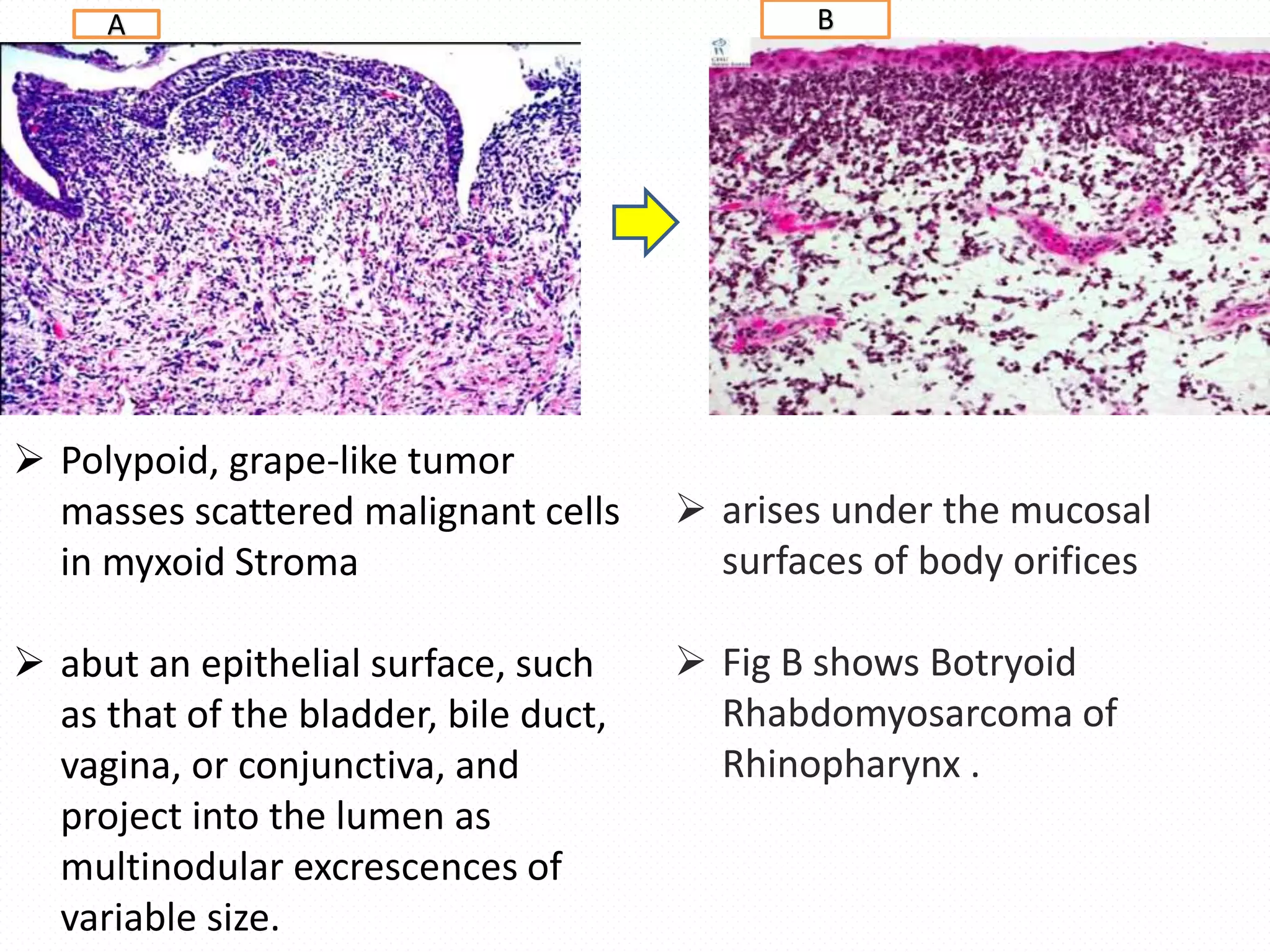 Rhabdomyosarcoma | PPTX