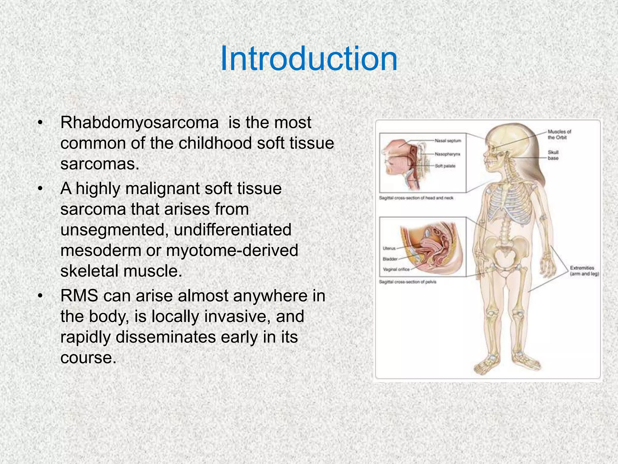 Rhabdomyosarcoma.pptx
