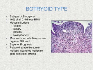 Rhabdomyosarcoma.pptx