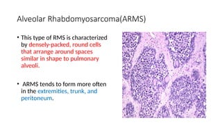 management of the Rhabdomyosarcoma.pptx