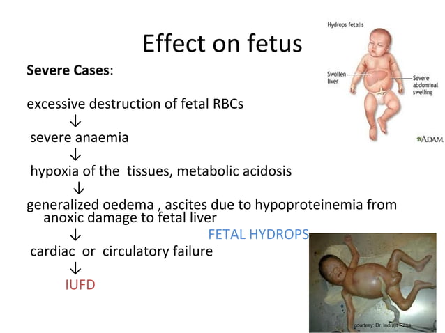 Rh alloimmunization | PPT