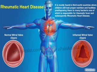 Rhd | PPTX | Heart and Cardiovascular Diseases | Diseases and Conditions
