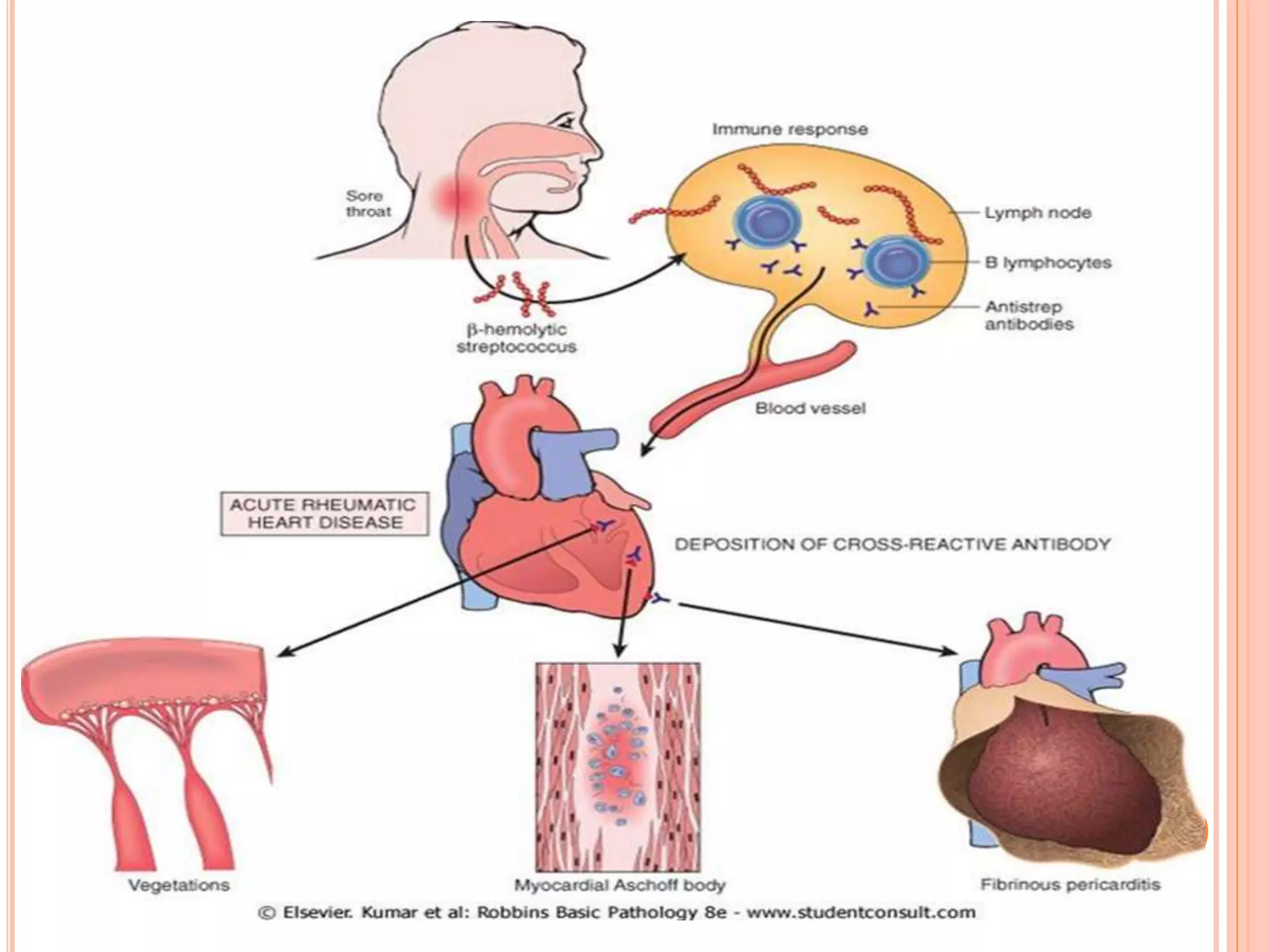RHD- Rheumatic Heart Disease , VHD - Valvular Heart Disease | PPTX