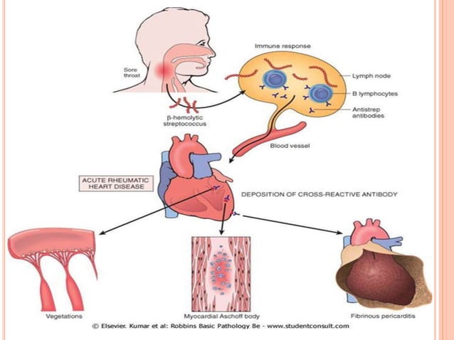 RHD- Rheumatic Heart Disease , VHD - Valvular Heart Disease | PPTX ...