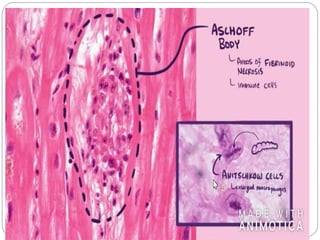 Rheumatic heart disease and their features.pptx