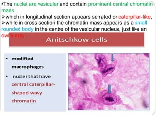 Rheumatic heart disease and their features.pptx