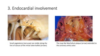 RHEUMATIC FEVER AND RHEUMATIC HEART DISEASE.pdf