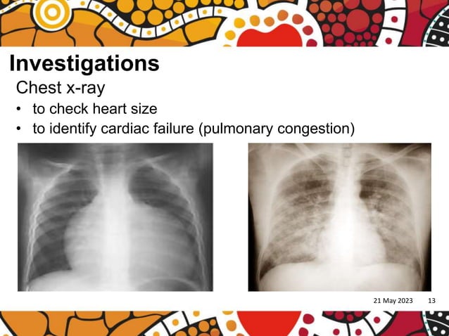 rhd_diagnosis_management.pptx